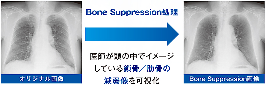 Bone Suppression処理（胸部骨減弱処理） | コニカミノルタ